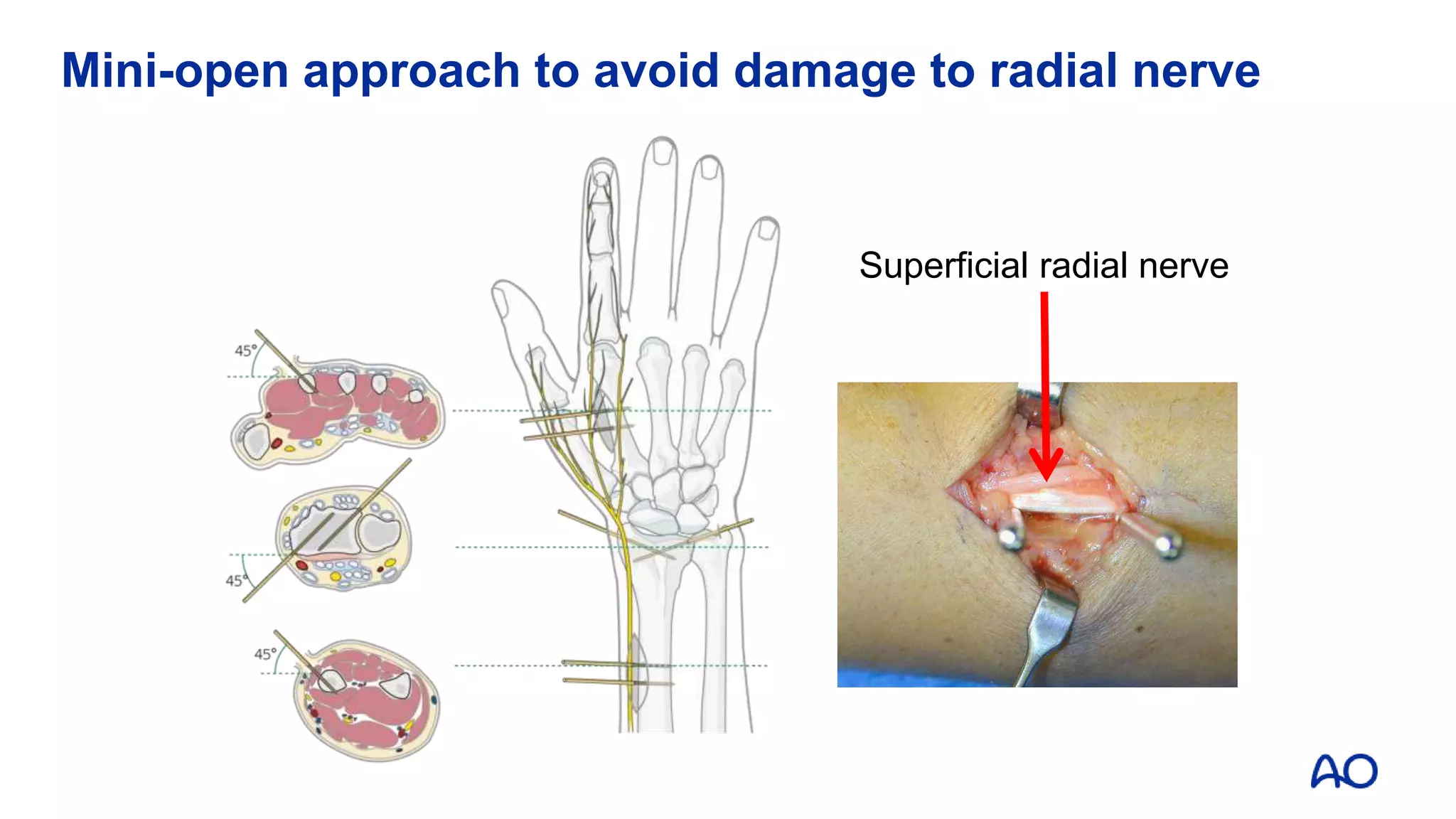11. Distal radial fractures; management principles.pptx