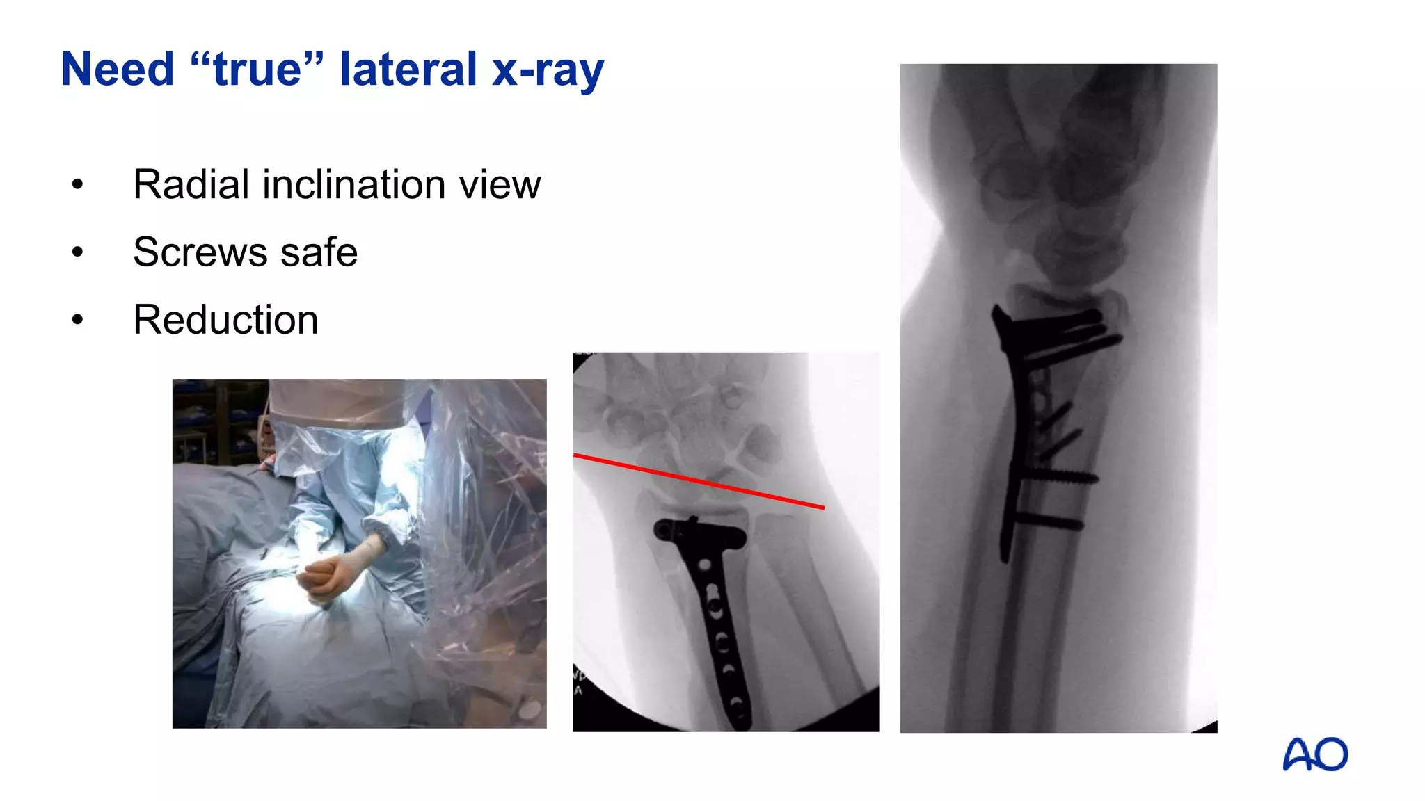 11. Distal radial fractures; management principles.pptx