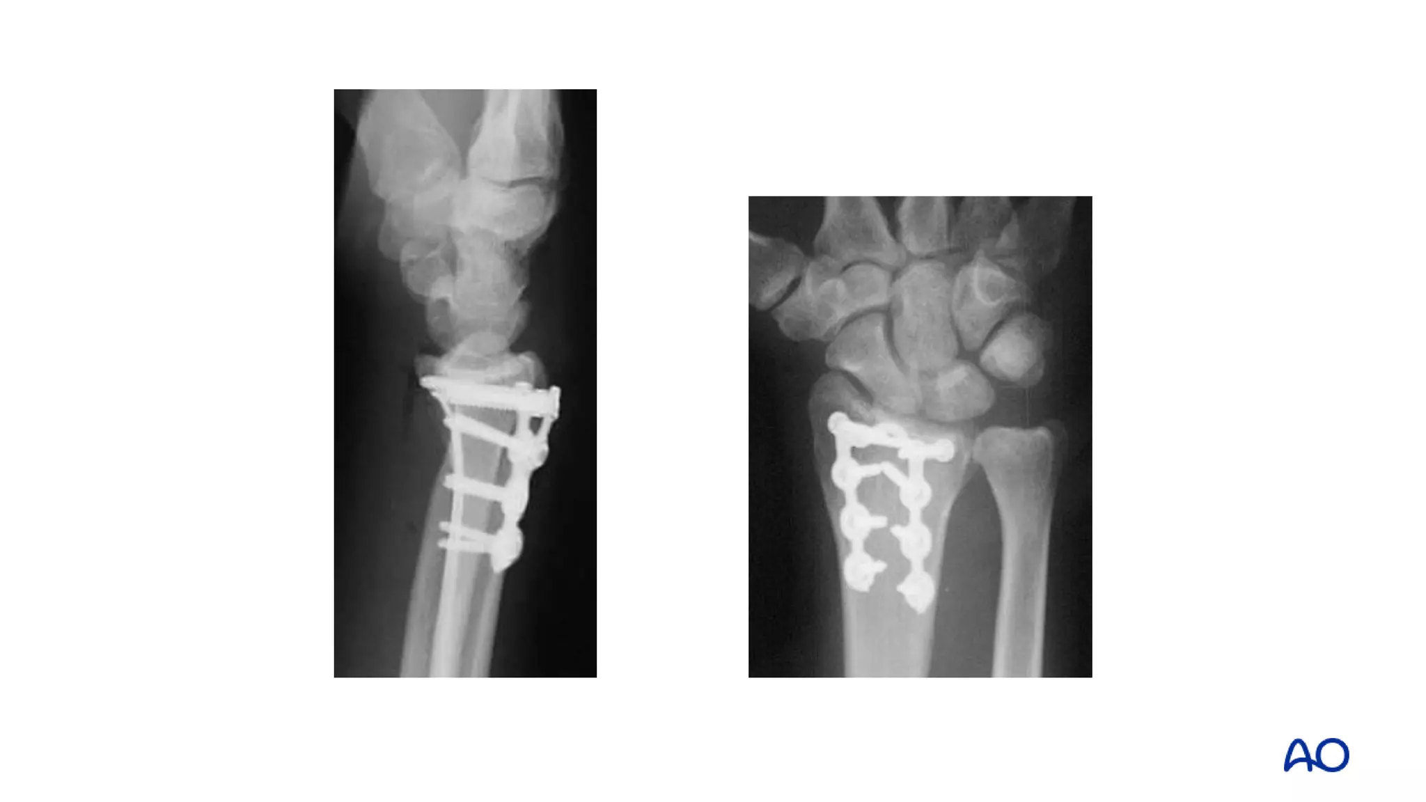 11 Distal Radial Fractures Management Principlespptx