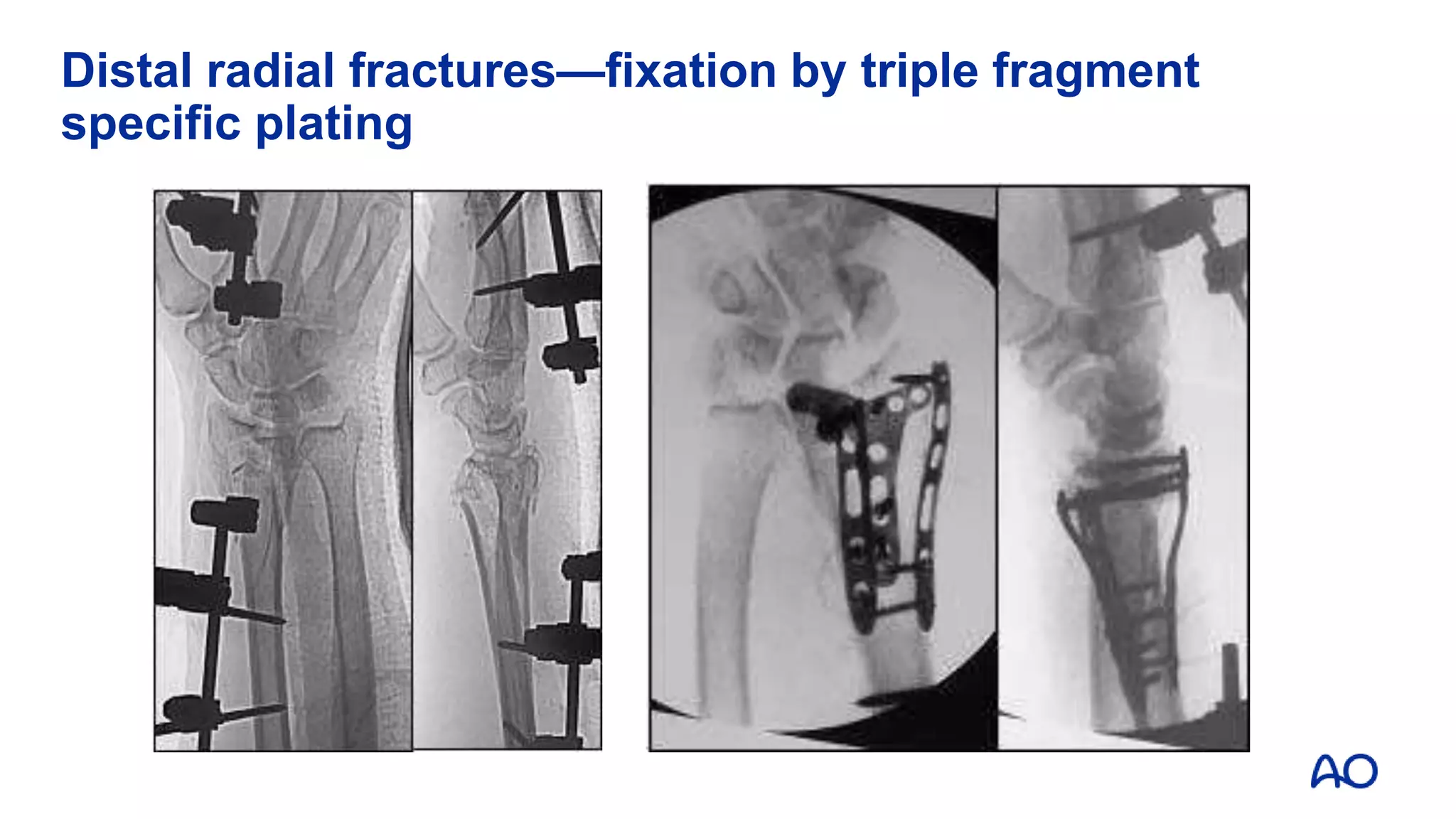 11. Distal radial fractures; management principles.pptx