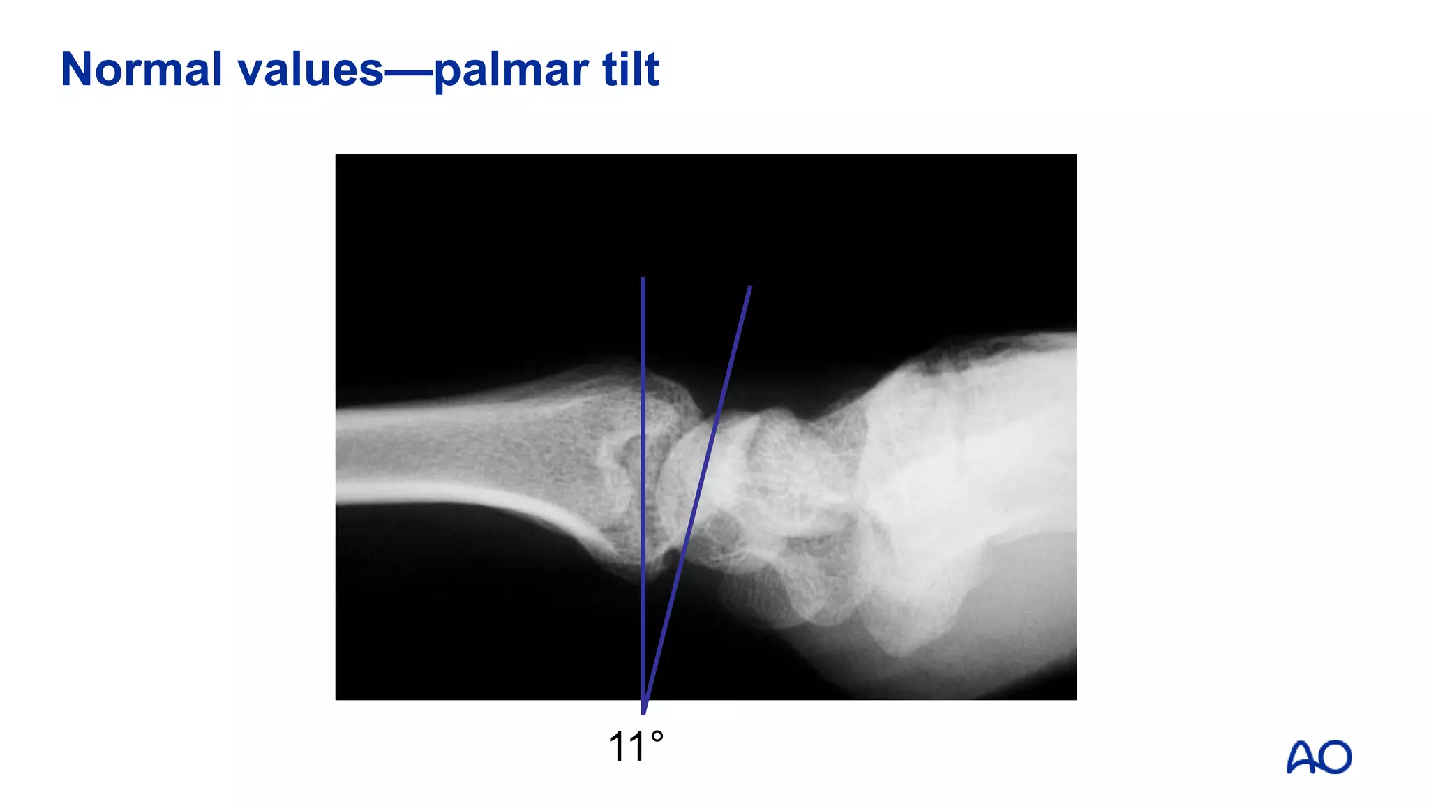 11. Distal radial fractures; management principles.pptx