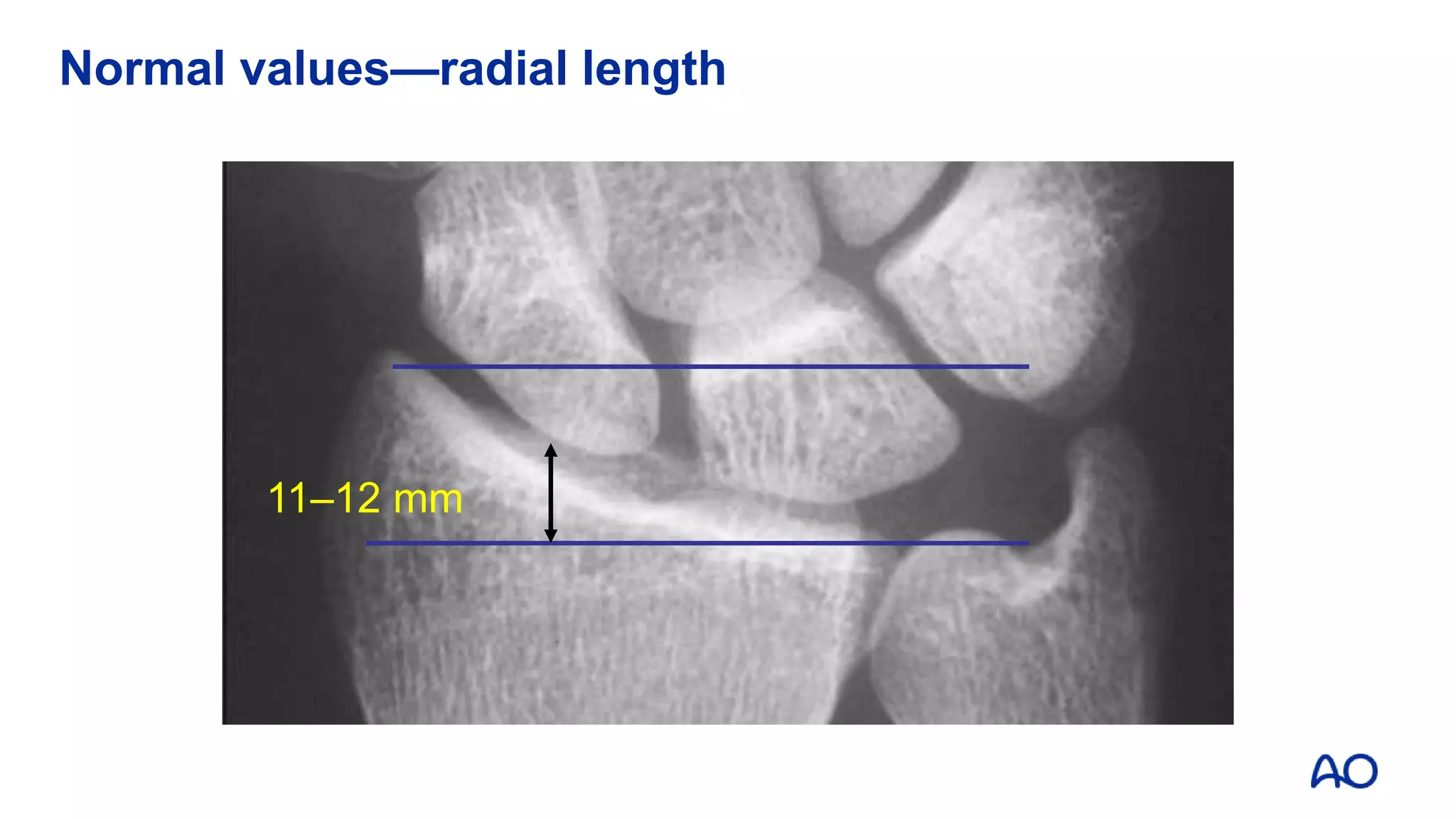 11. Distal radial fractures; management principles.pptx