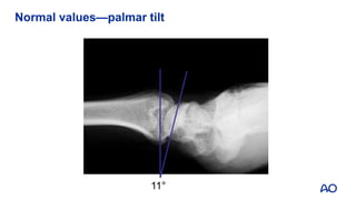 11. Distal radial fractures; management principles.pptx