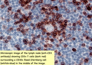 Hodgkin Lymphoma………………………………………………...pdf