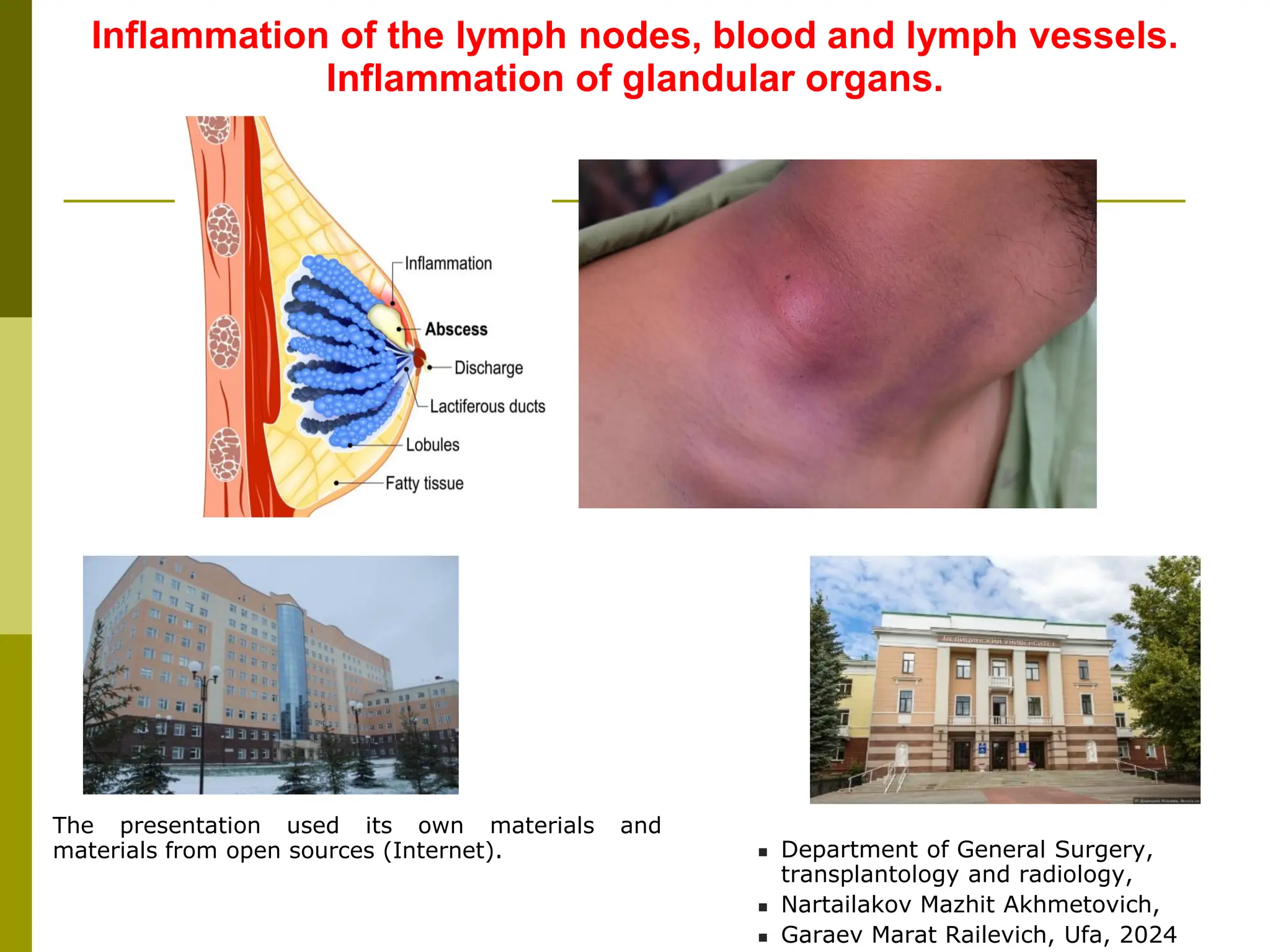 Inflammation of the lymph nodes, blood and lymph vessels. Inflammation ...
