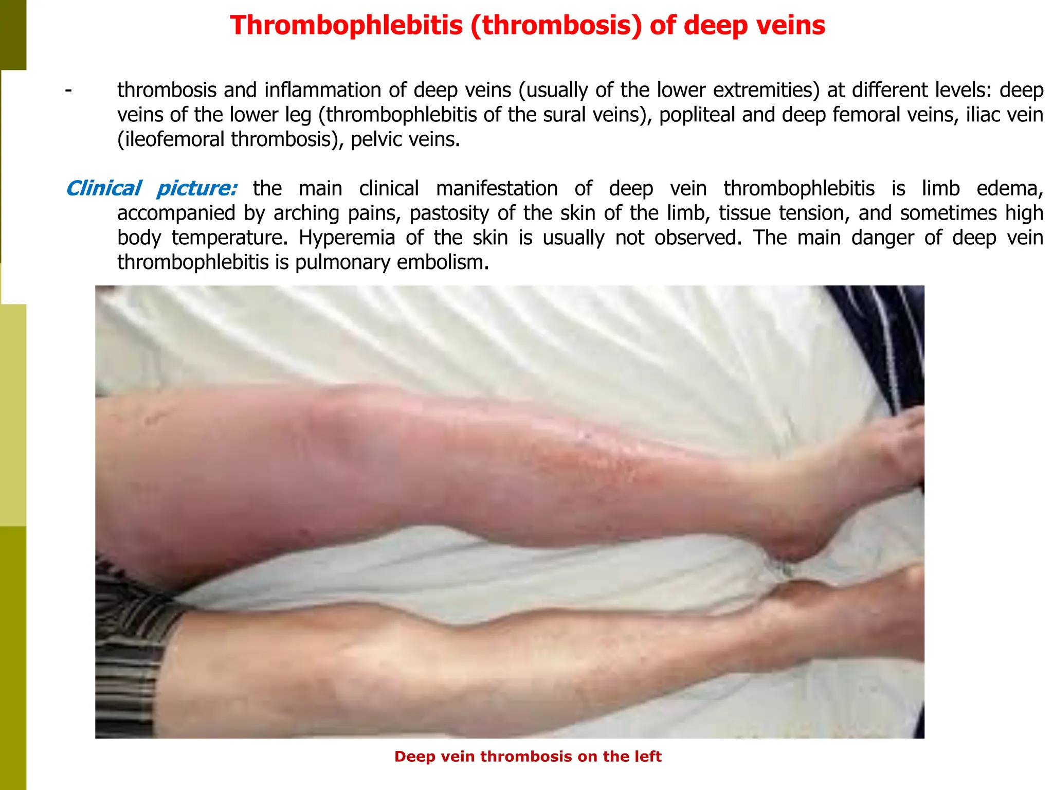 Inflammation of the lymph nodes, blood and lymph vessels. Inflammation ...