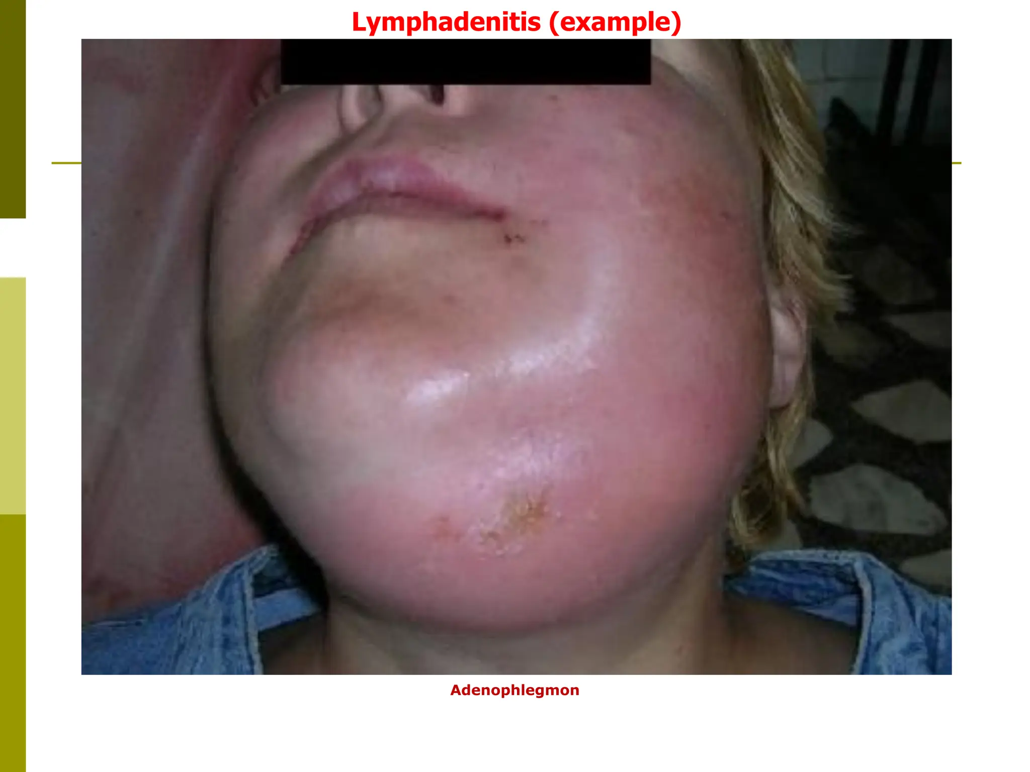 Inflammation of the lymph nodes, blood and lymph vessels. Inflammation ...