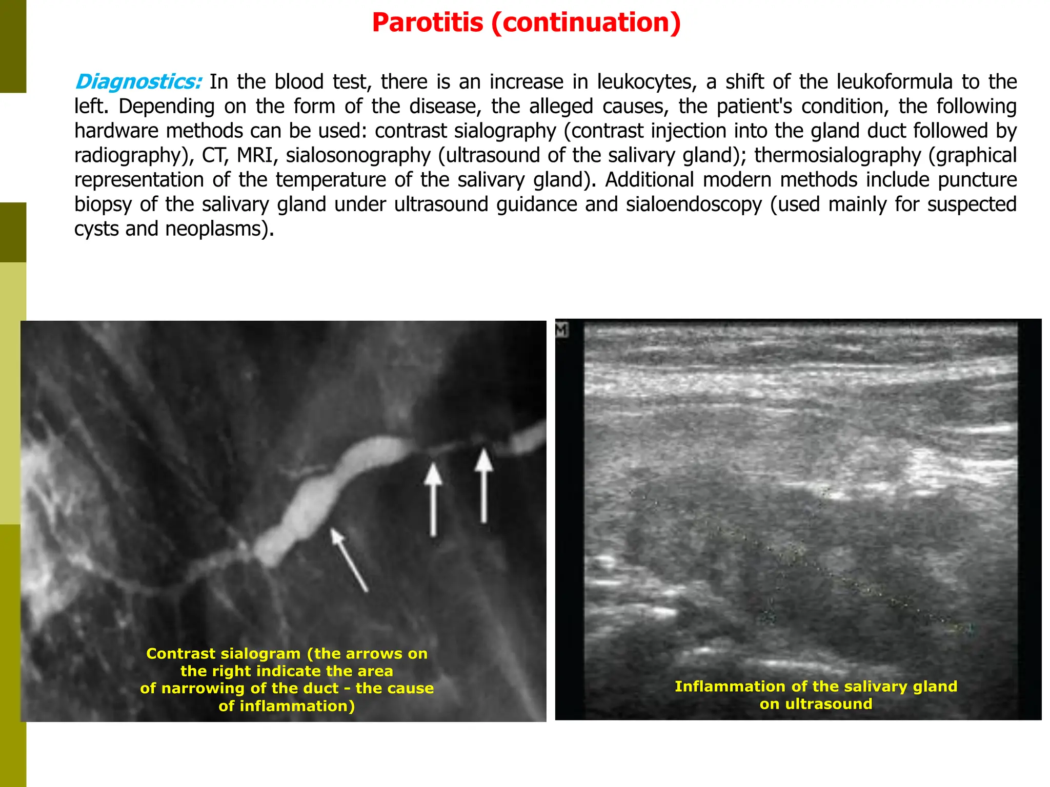 Inflammation of the lymph nodes, blood and lymph vessels. Inflammation ...