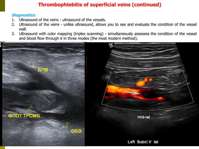 Inflammation of the lymph nodes, blood and lymph vessels. Inflammation ...