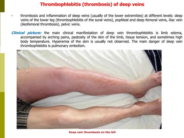 Inflammation of the lymph nodes, blood and lymph vessels. Inflammation ...