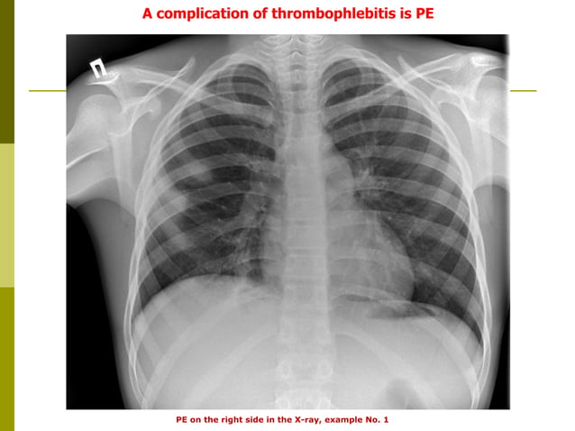 Inflammation of the lymph nodes, blood and lymph vessels. Inflammation ...