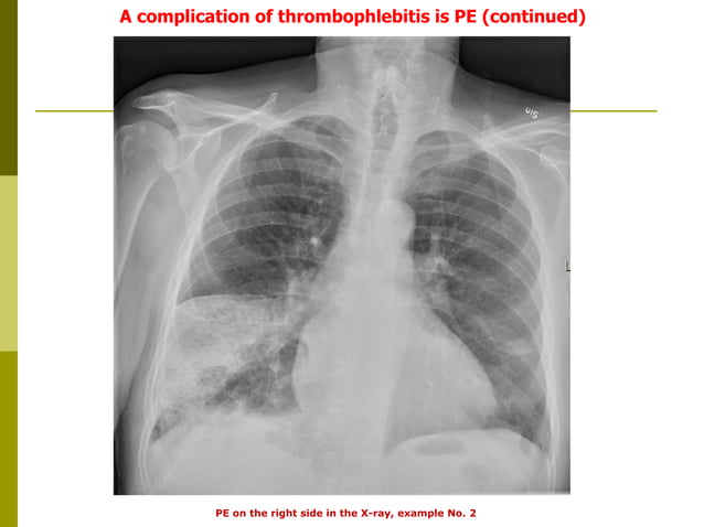Inflammation of the lymph nodes, blood and lymph vessels. Inflammation ...