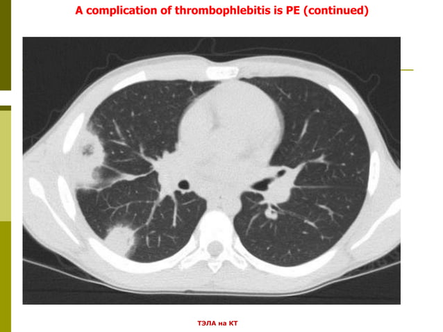 Inflammation of the lymph nodes, blood and lymph vessels. Inflammation ...