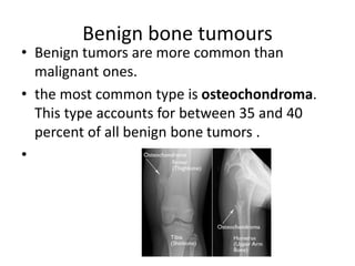 11. BONE NEOPLASMS in Medical Pathology.pptx