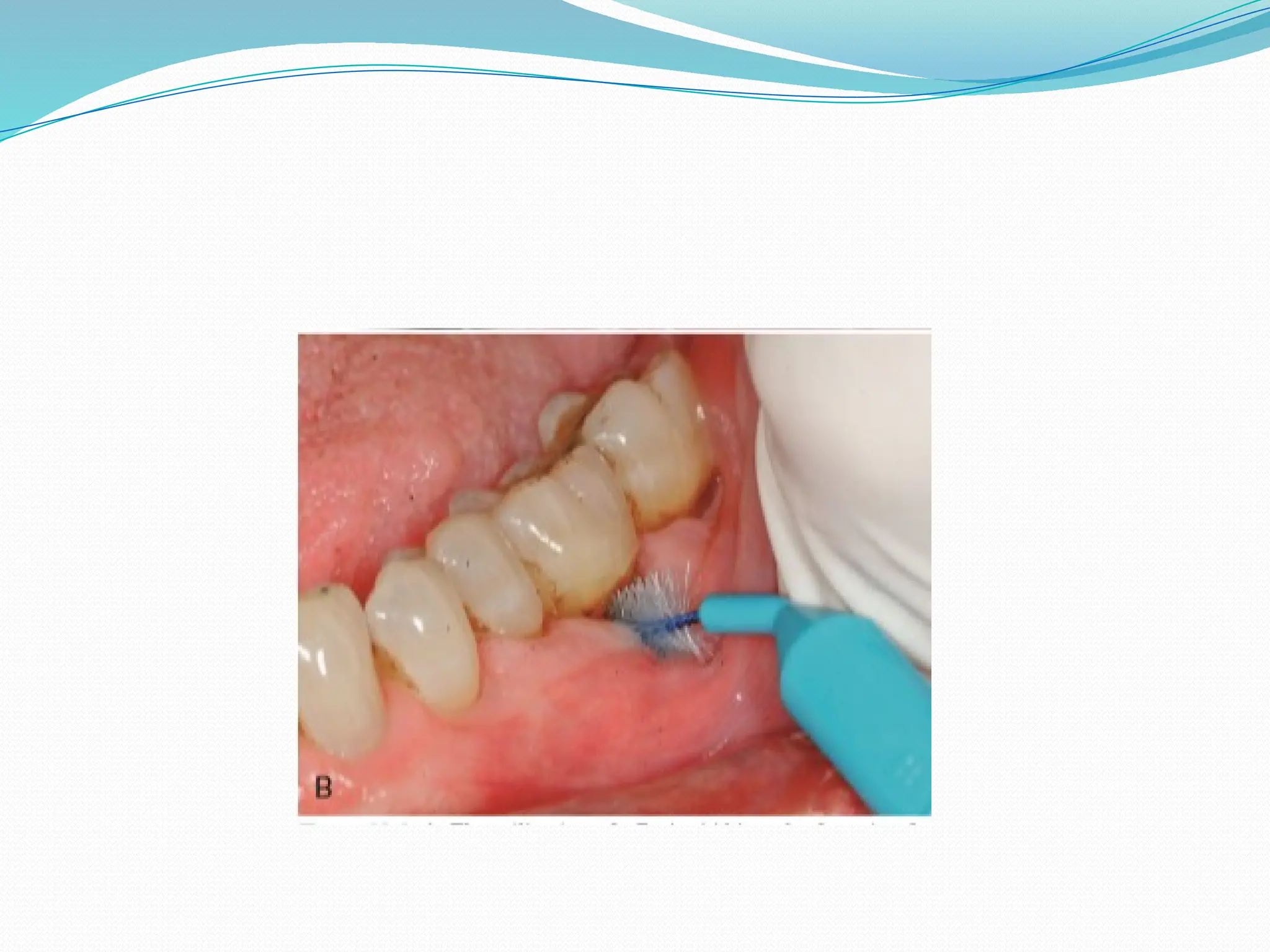 11. Treatment of Furcation Involvement.pptx
