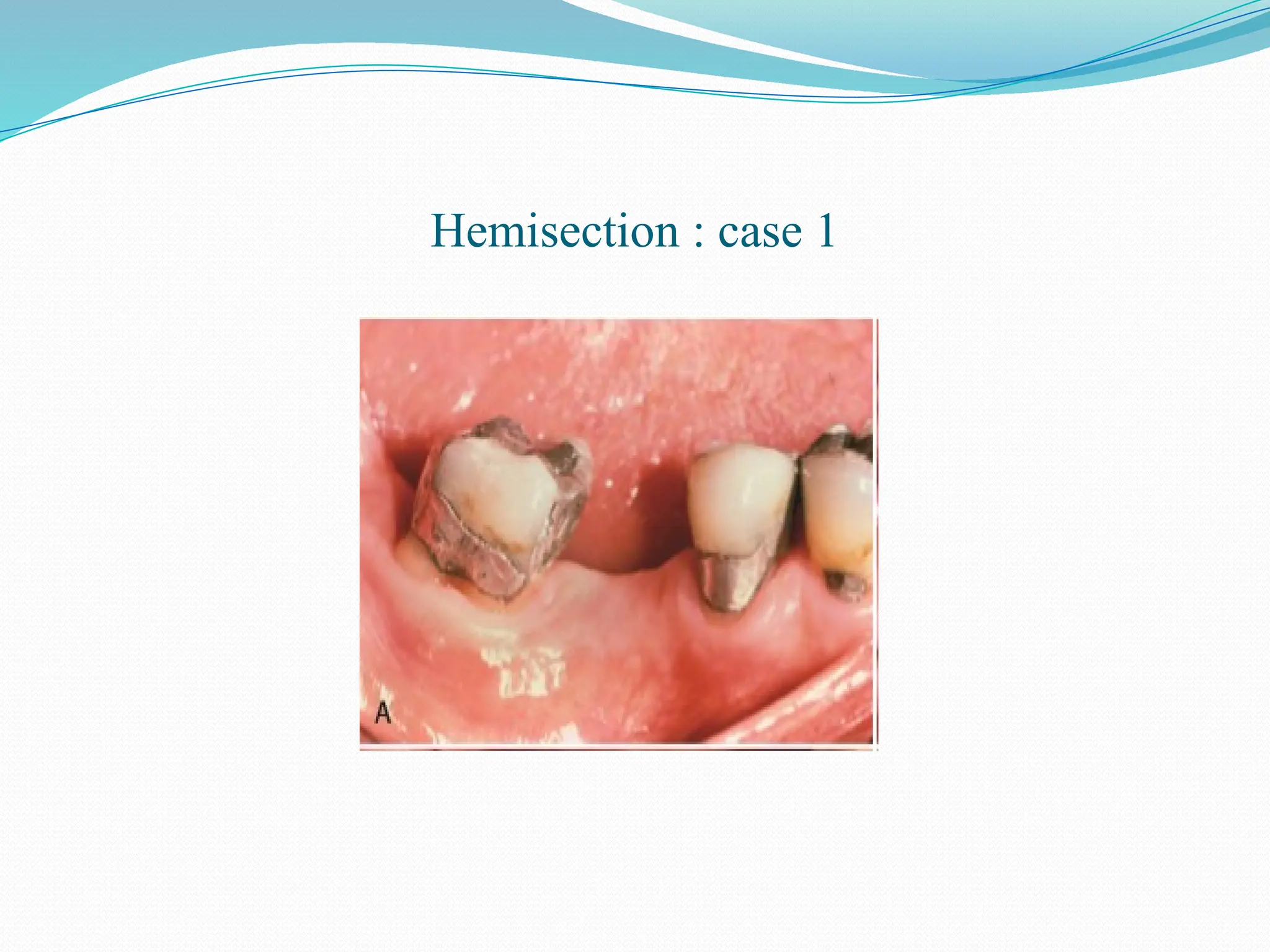 11. Treatment of Furcation Involvement.pptx