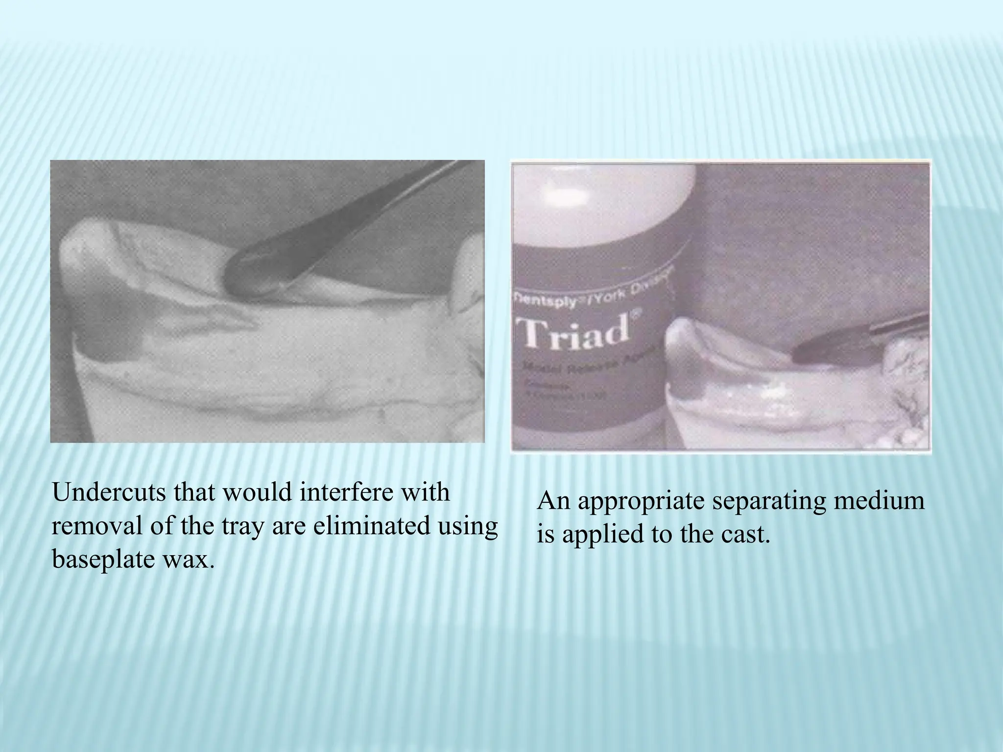 11.Special Impression Procedures For TooTH-Tissue-Supported removable ...