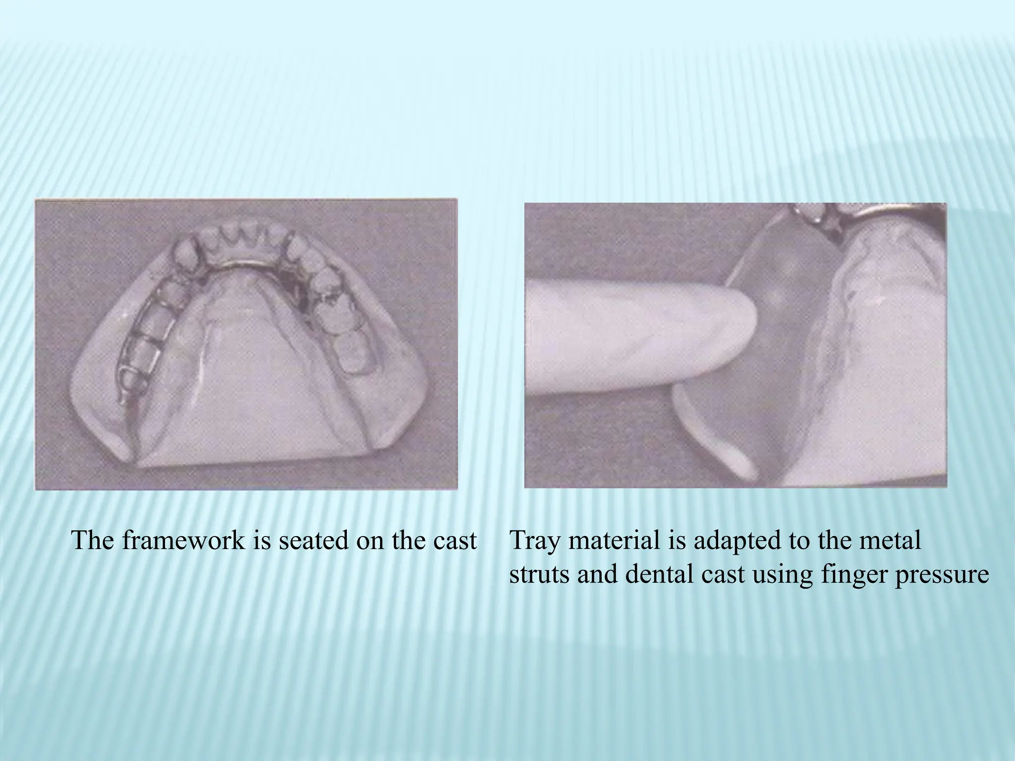 11.Special Impression Procedures For TooTH-Tissue-Supported removable ...