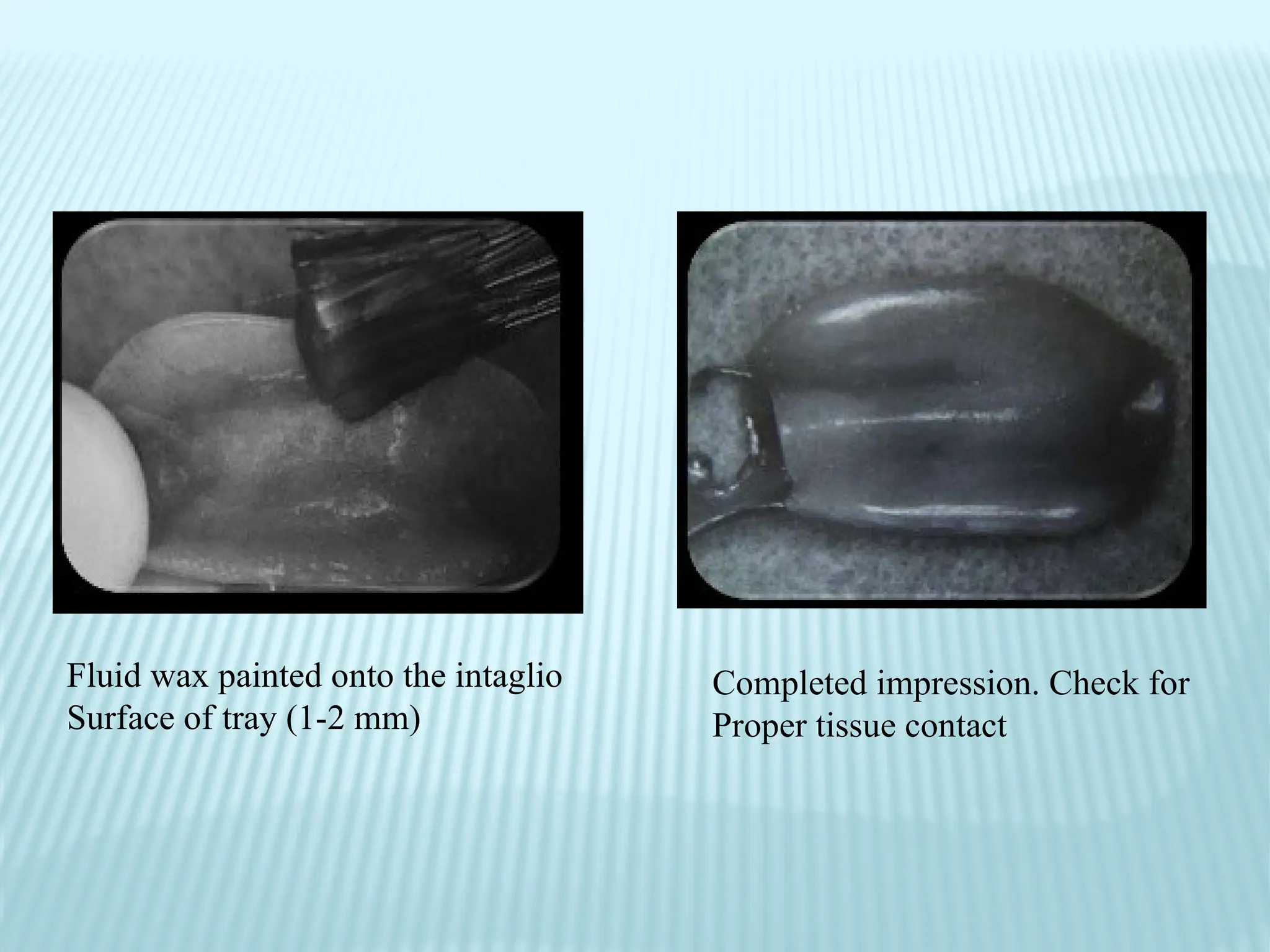 11.Special Impression Procedures For TooTH-Tissue-Supported removable ...