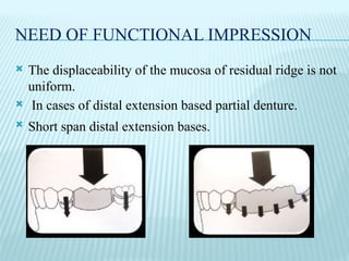 11.Special Impression Procedures For TooTH-Tissue-Supported removable ...