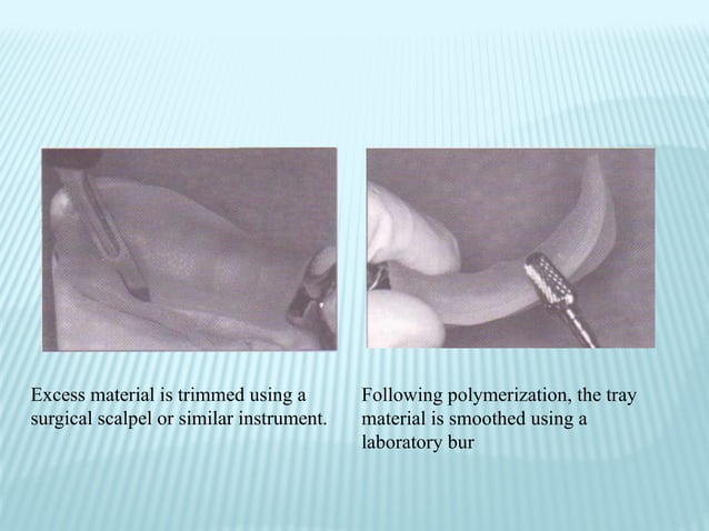11.Special Impression Procedures For TooTH-Tissue-Supported removable ...