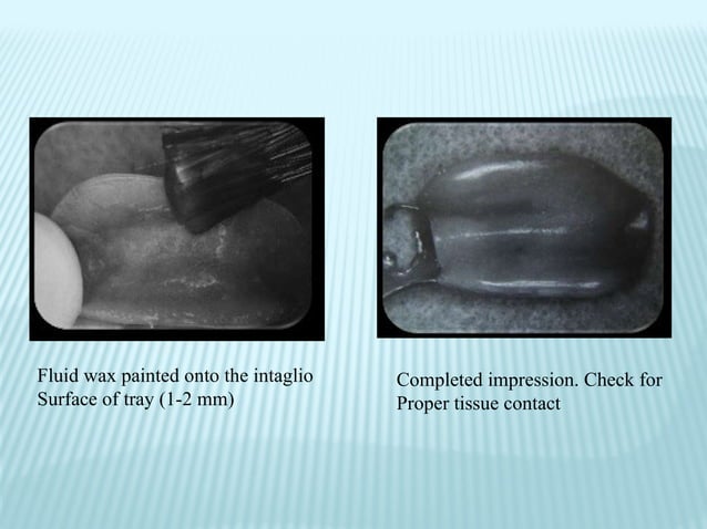 11.Special Impression Procedures For TooTH-Tissue-Supported removable ...