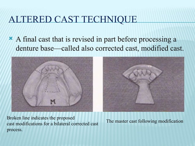 11.Special Impression Procedures For TooTH-Tissue-Supported removable ...