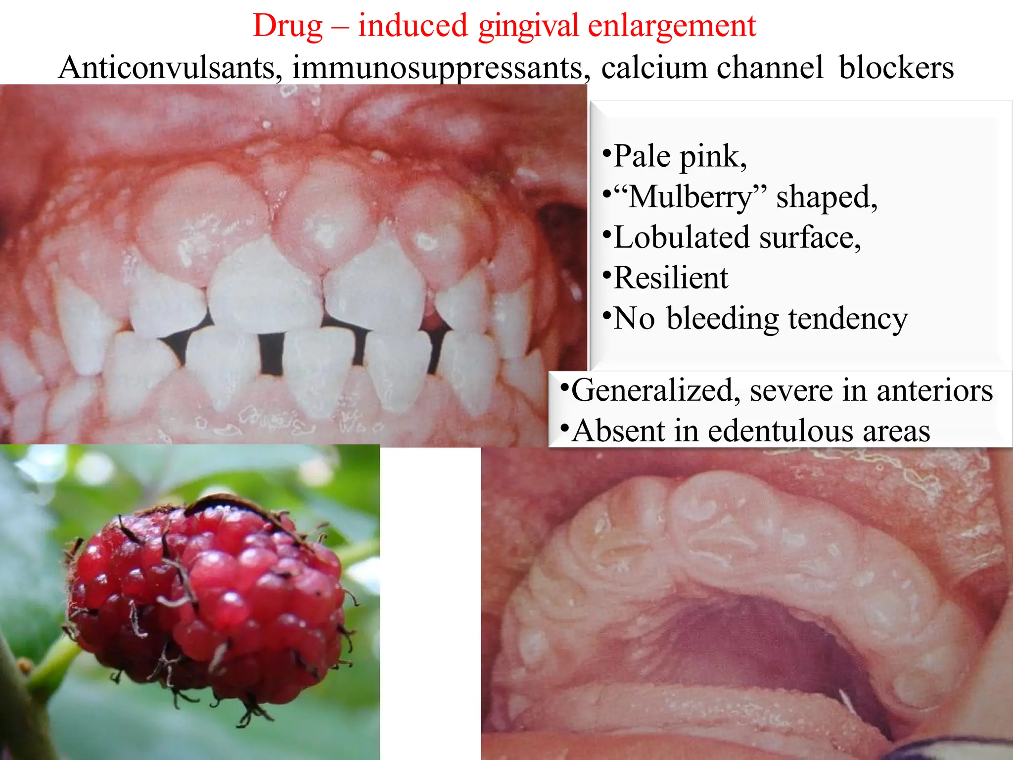 Types and classification of gingival enlargement | PPTX