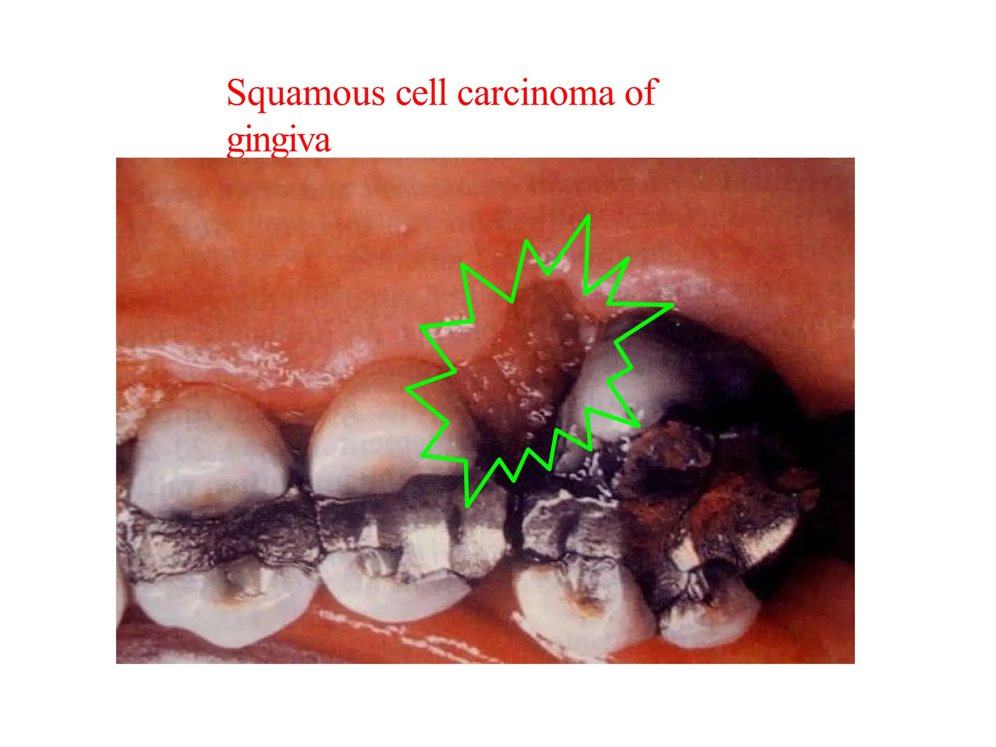 Types and classification of gingival enlargement | PPTX