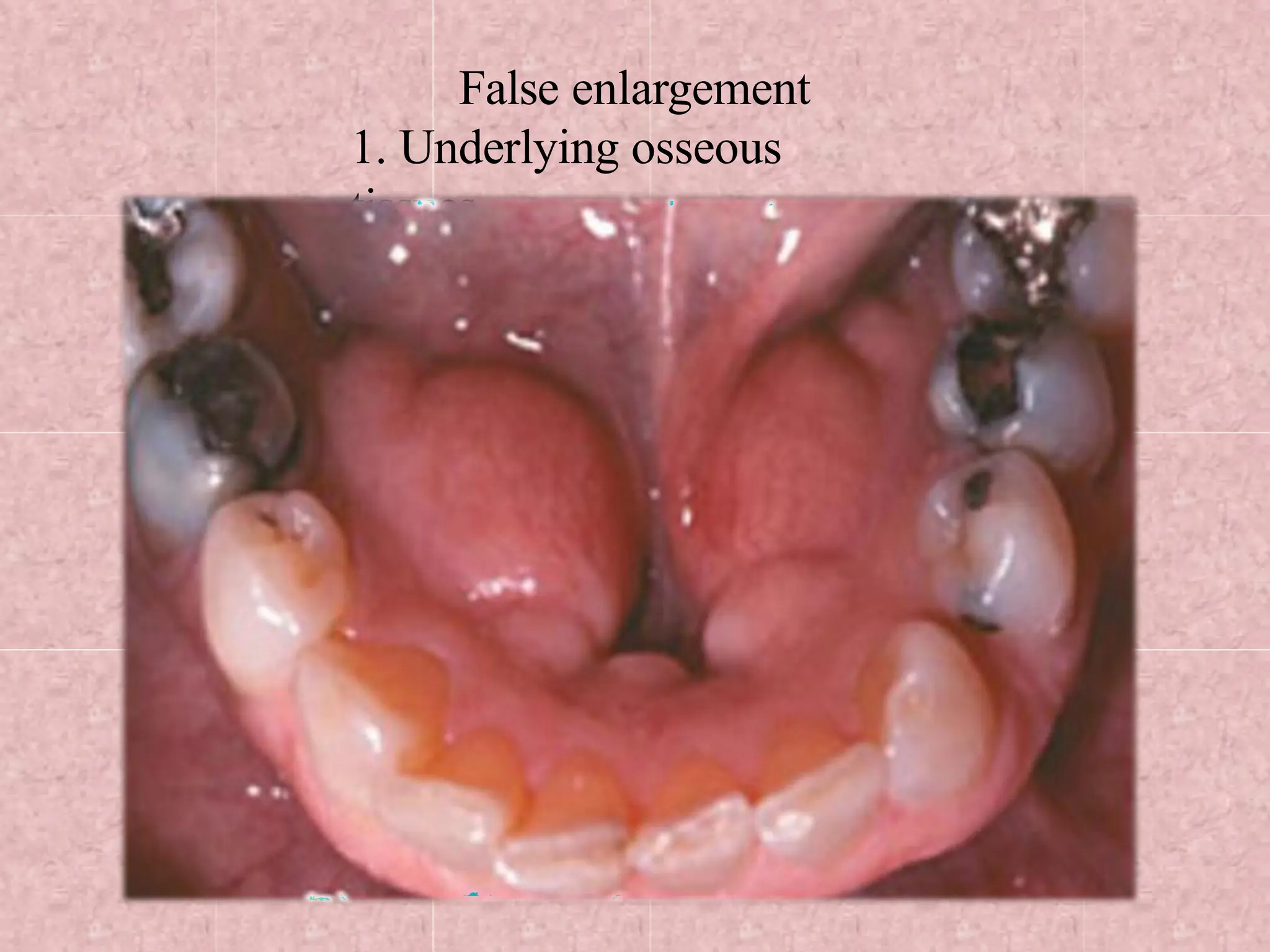 Types and classification of gingival enlargement | PPTX