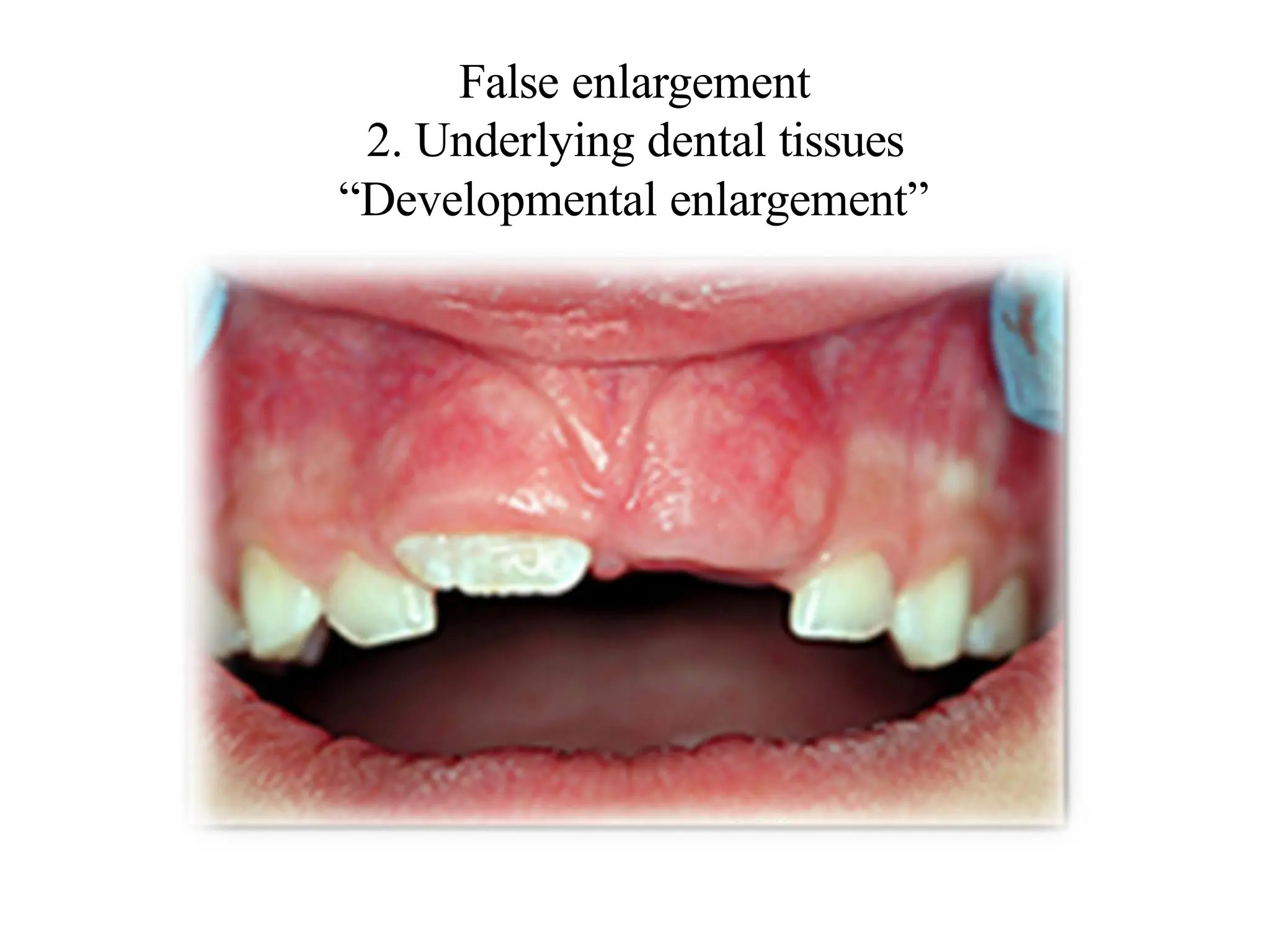 Types and classification of gingival enlargement | PPTX