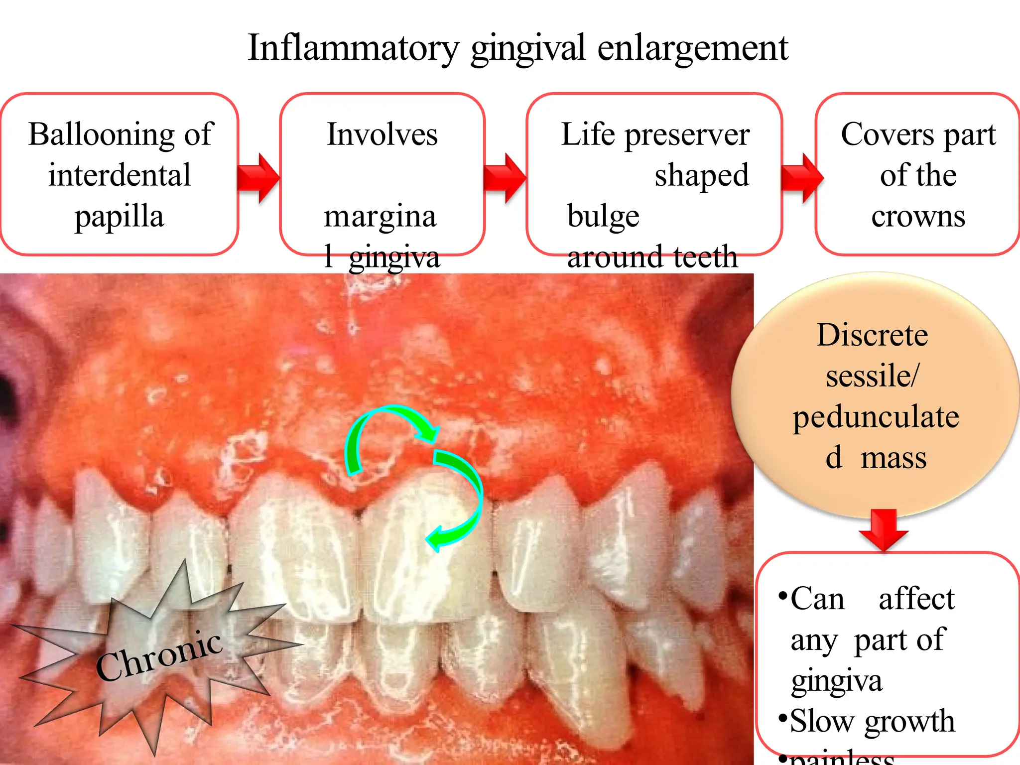 Types and classification of gingival enlargement | PPTX