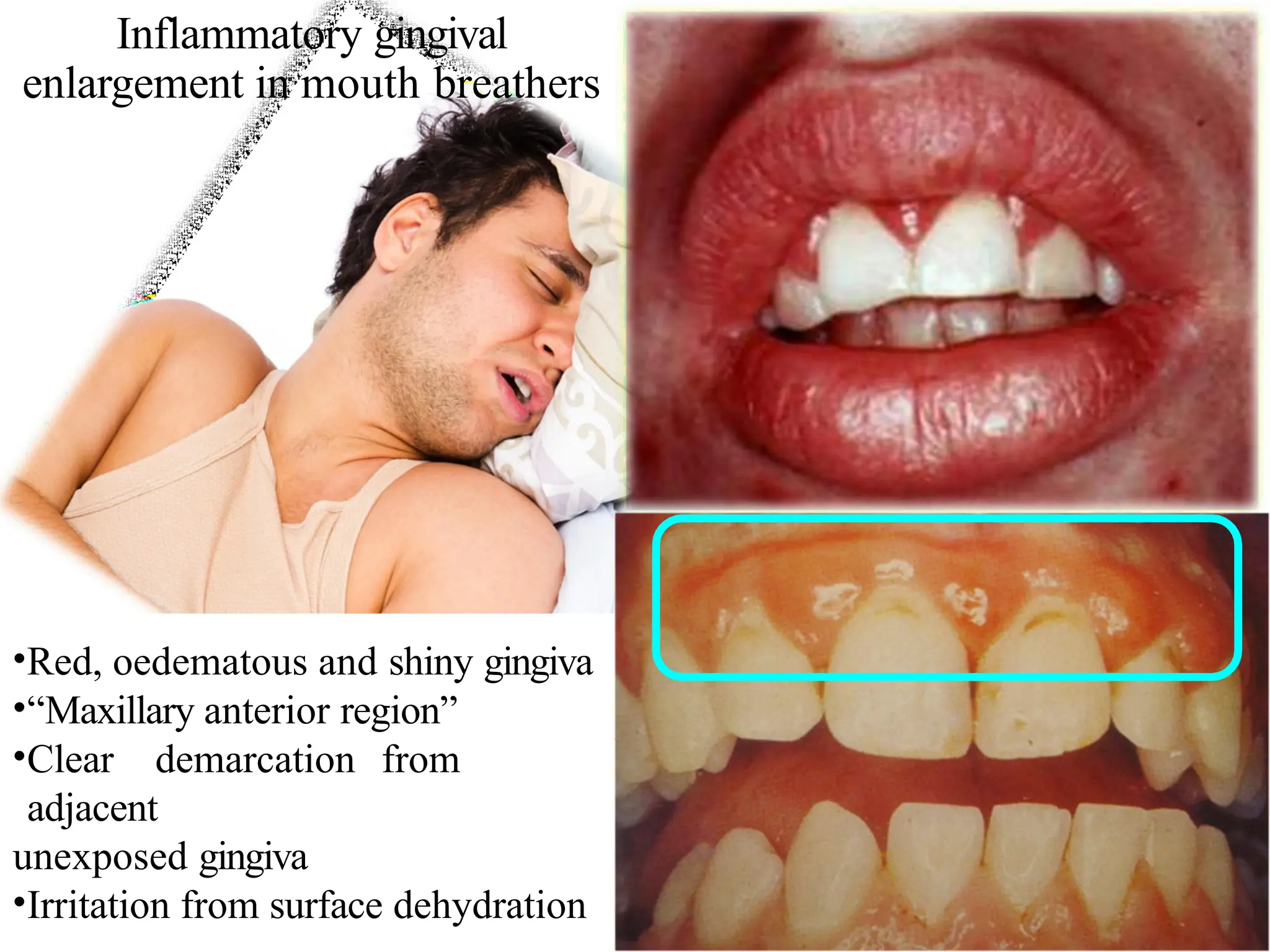 Types and classification of gingival enlargement | PPTX