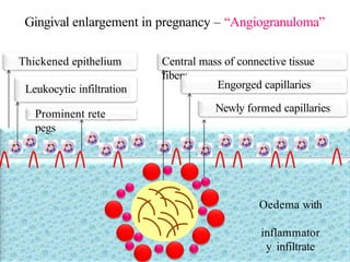 Types and classification of gingival enlargement | PPTX