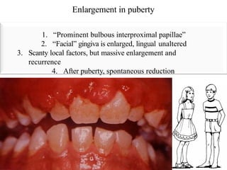 Types and classification of gingival enlargement | PPTX