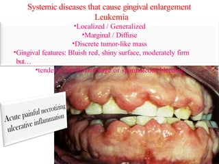 Types and classification of gingival enlargement | PPT