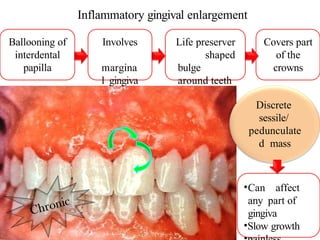 Types and classification of gingival enlargement | PPTX