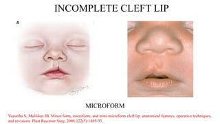 management of Cleft Lip, management of cleft lip and palate | PPTX