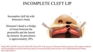 management of Cleft Lip, management of cleft lip and palate | PPTX