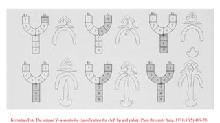 management of Cleft Lip, management of cleft lip and palate | PPTX