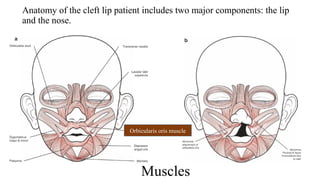 management of Cleft Lip, management of cleft lip and palate | PPTX