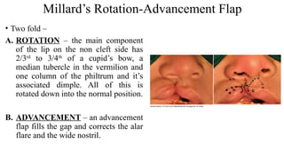 management of Cleft Lip, management of cleft lip and palate | PPTX