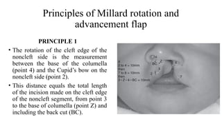 management of Cleft Lip, management of cleft lip and palate | PPTX