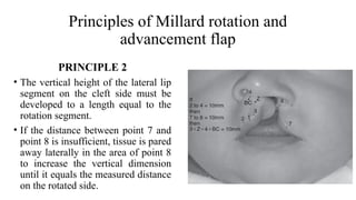 management of Cleft Lip, management of cleft lip and palate | PPTX
