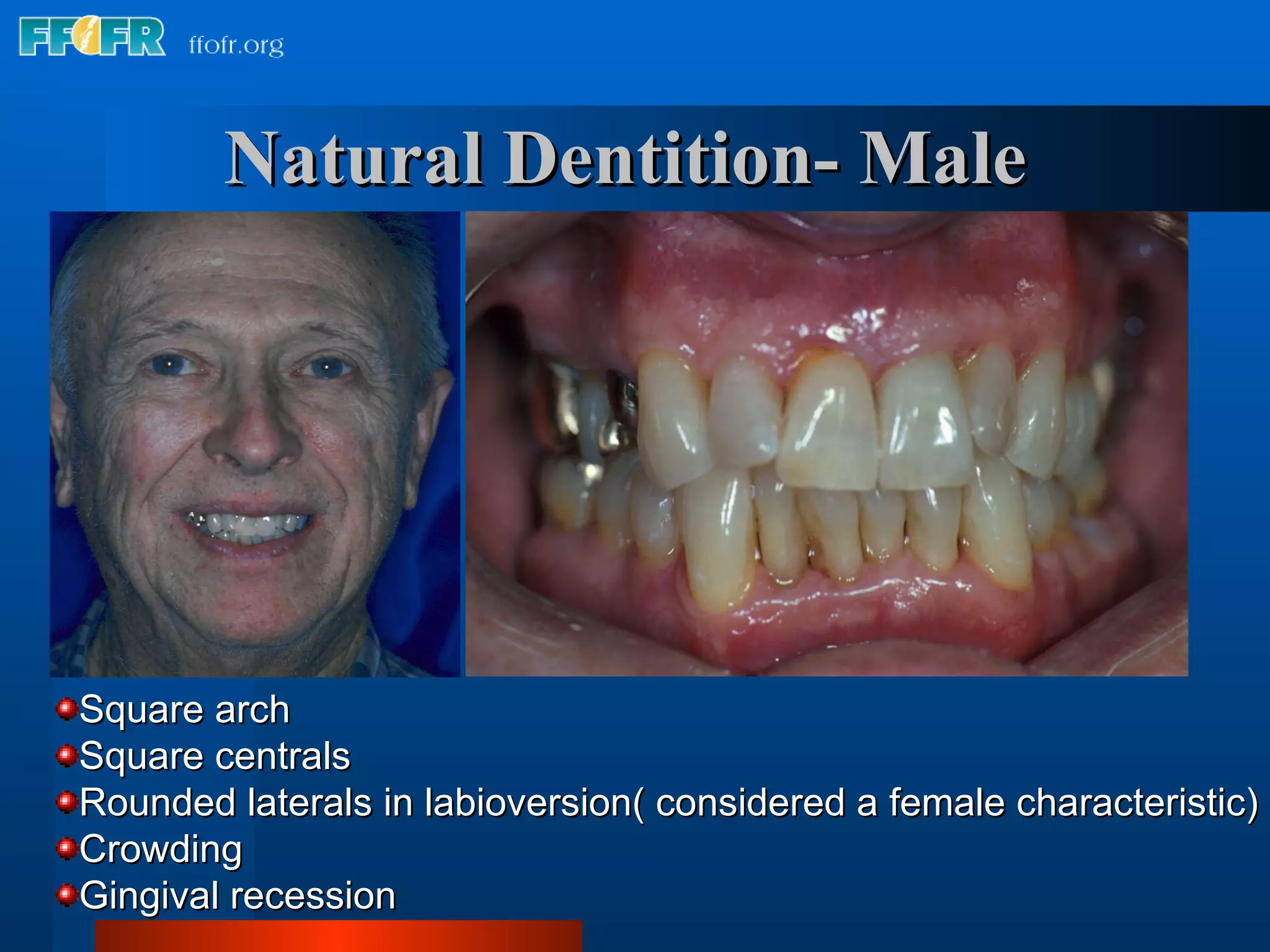 11.anterior tooth selection | PPT
