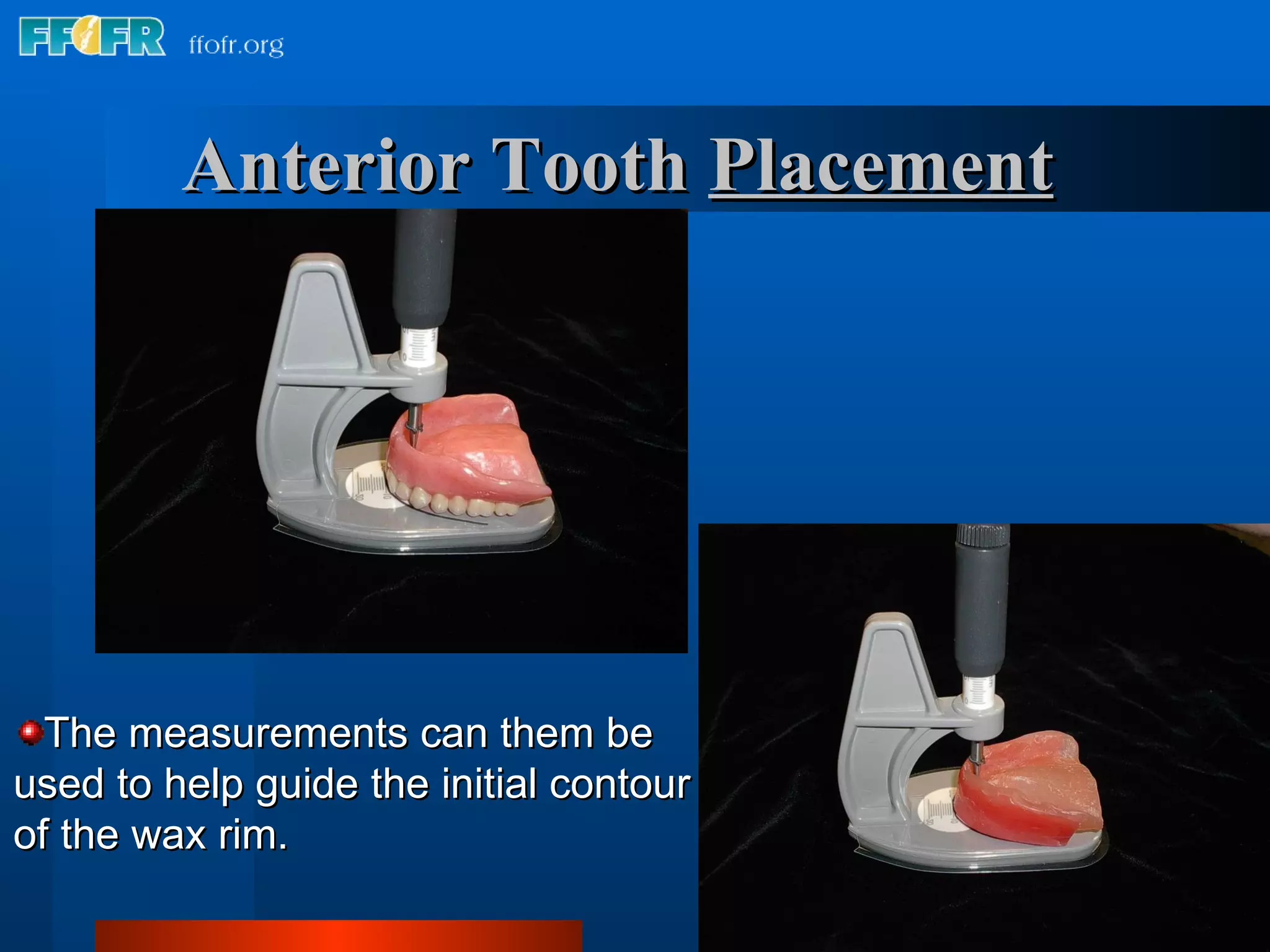 11.anterior tooth selection | PPT
