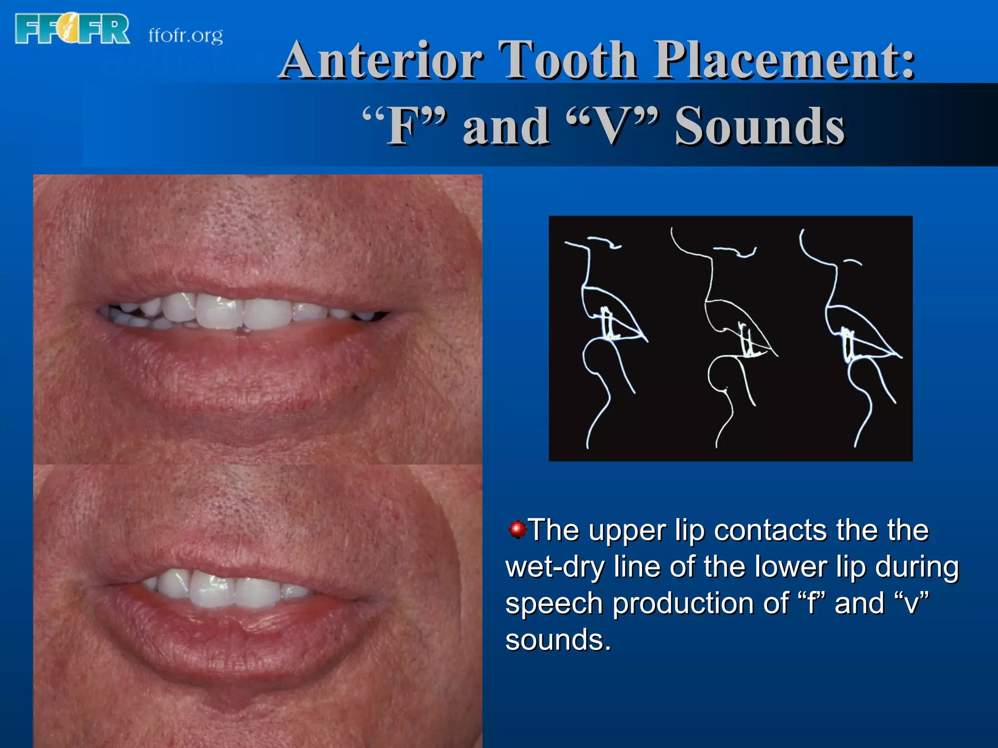 11.anterior tooth selection | PPT