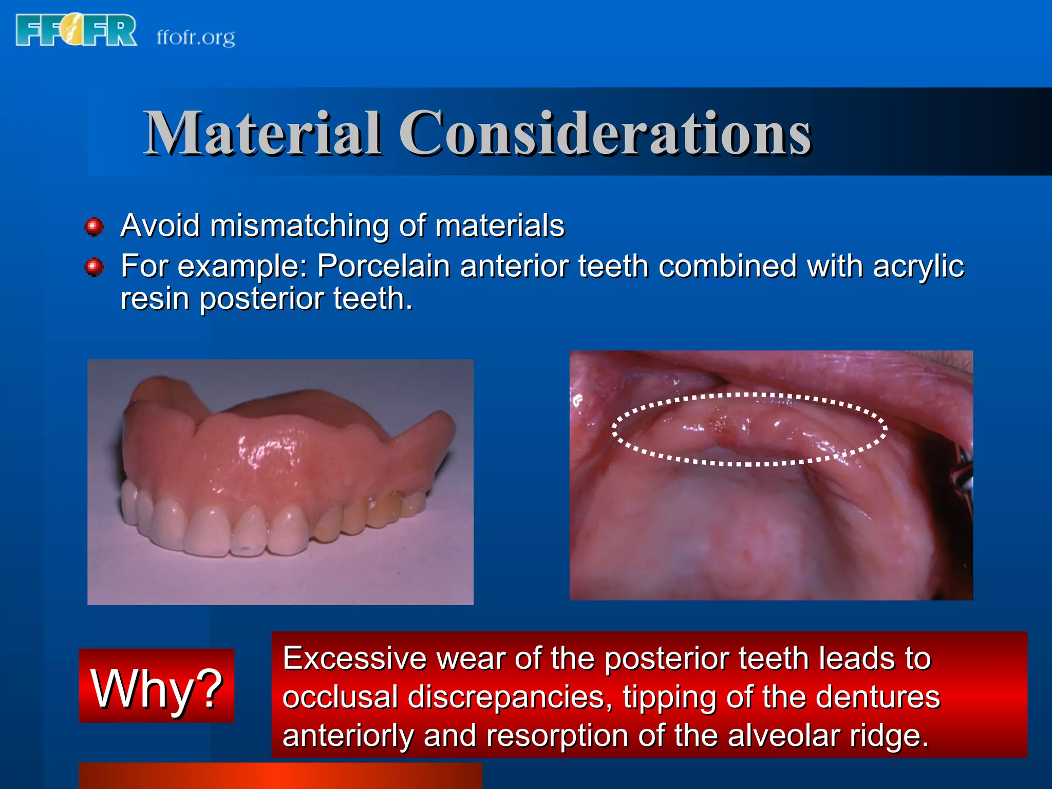 11.anterior tooth selection | PPT