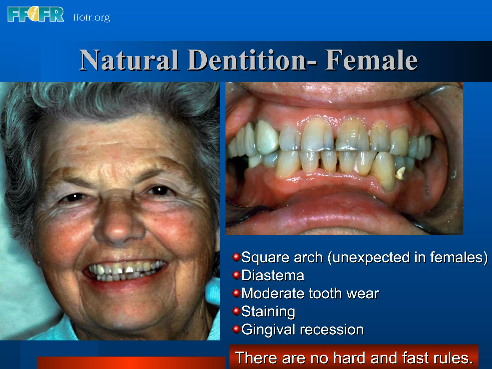 11.anterior tooth selection | PPT