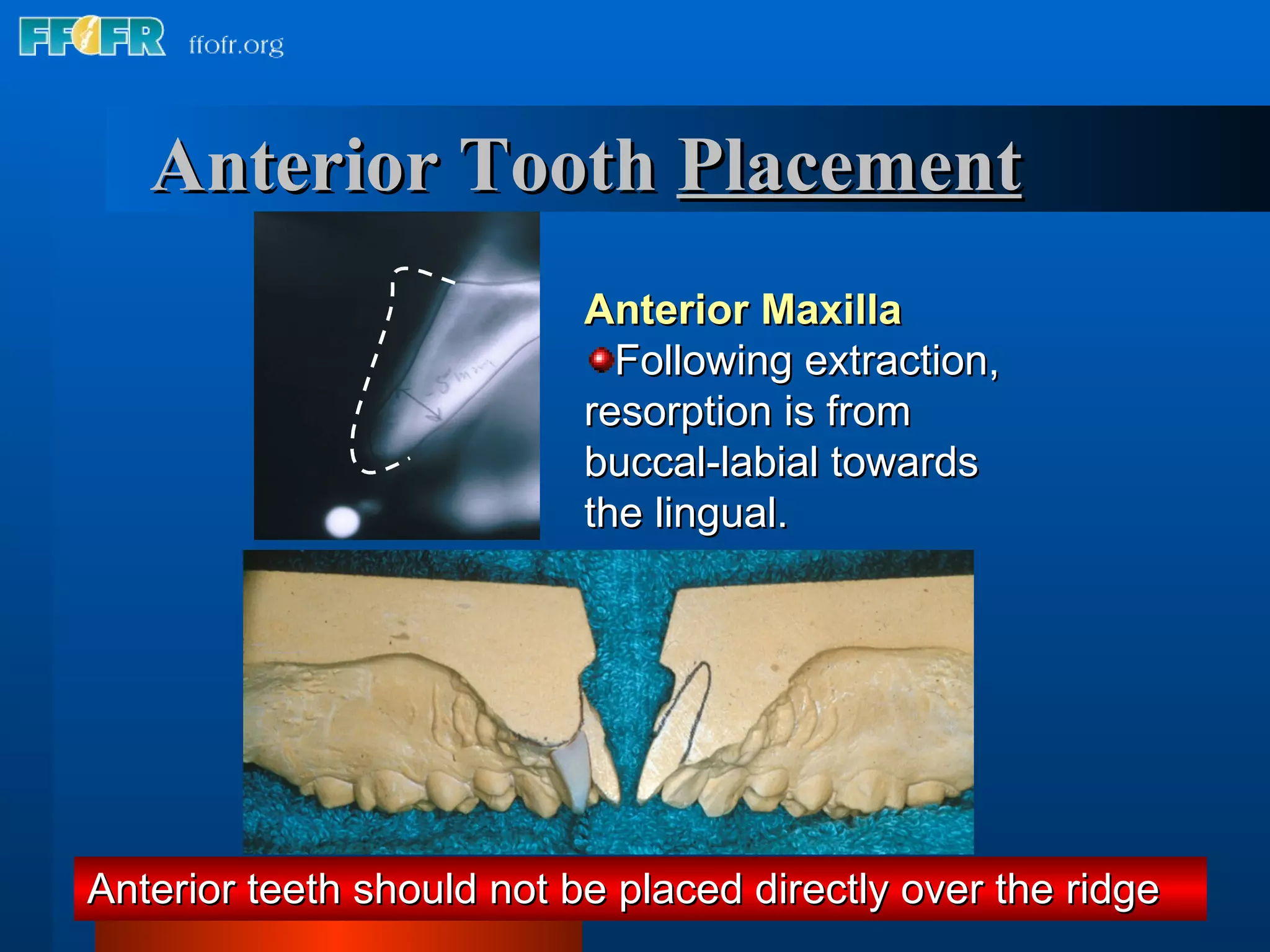 11.anterior tooth selection | PPT